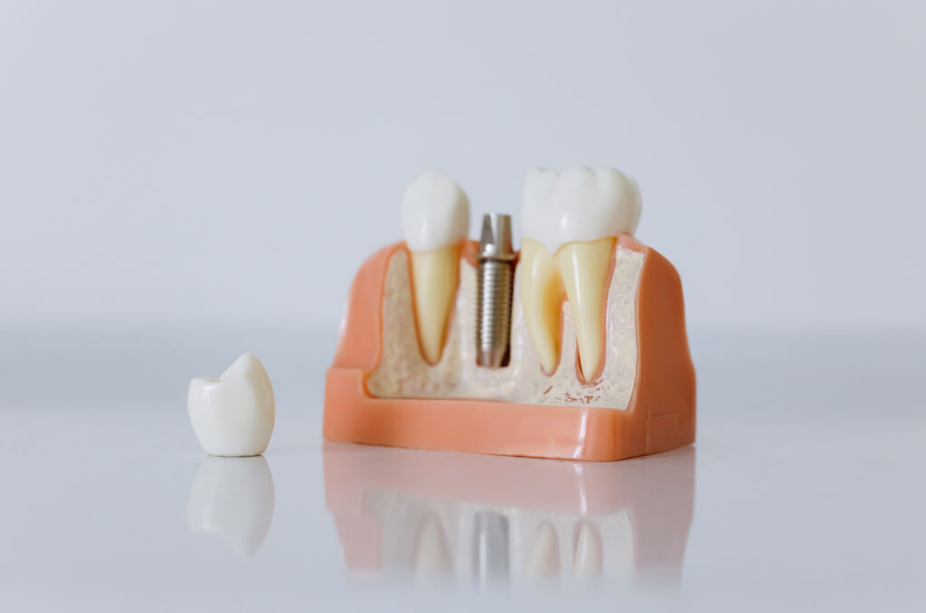 Surgical Tooth Extraction & Orthodontic Clearance | Sacramento ...